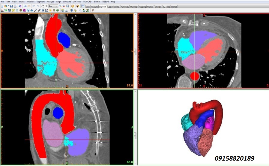 کلینیک تخصصی نرم افزار میمیکس (mimics) | انجام پروژه میمیکس